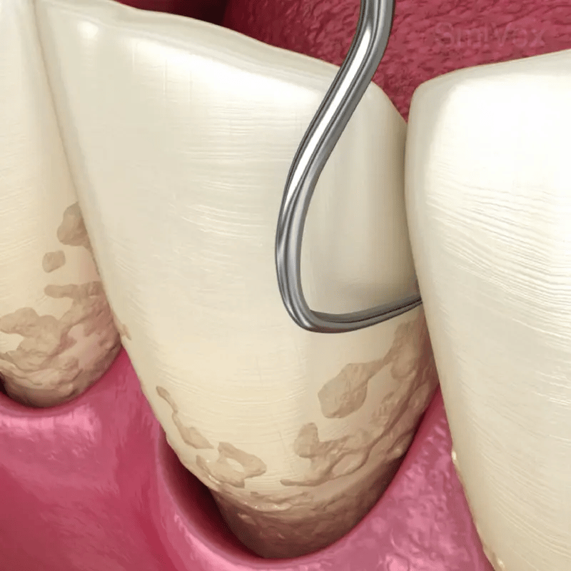 How to Remove Tartar at Home (Dentist Explains) – SmiVox